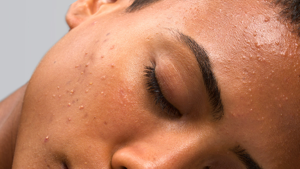 Why Is My Skin So Oily? Oily Skincare Routine Tips | CeraVe