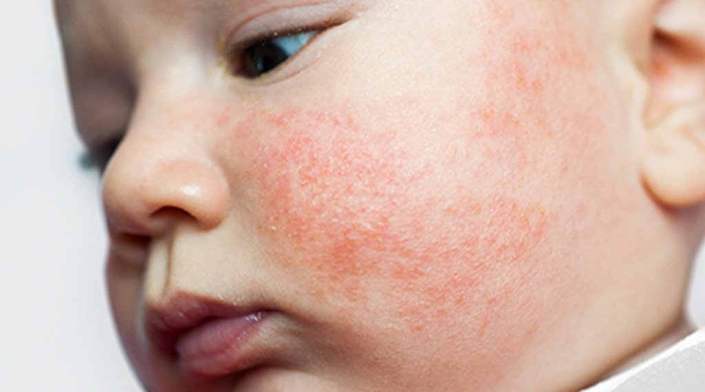 Baby Eczema - Symptoms, Causes, Treatment & Relief | CeraVe