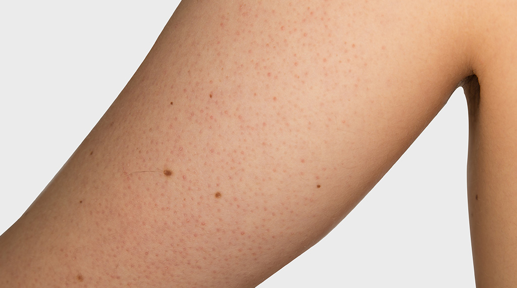 Your Bumpy Skin Might Be Keratosis Pilaris: Learn More Today | CeraVe