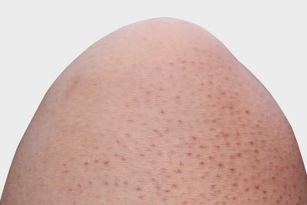 Rough, Dry Skin Patches: Causes, Prevention, and Treatment | CeraVe